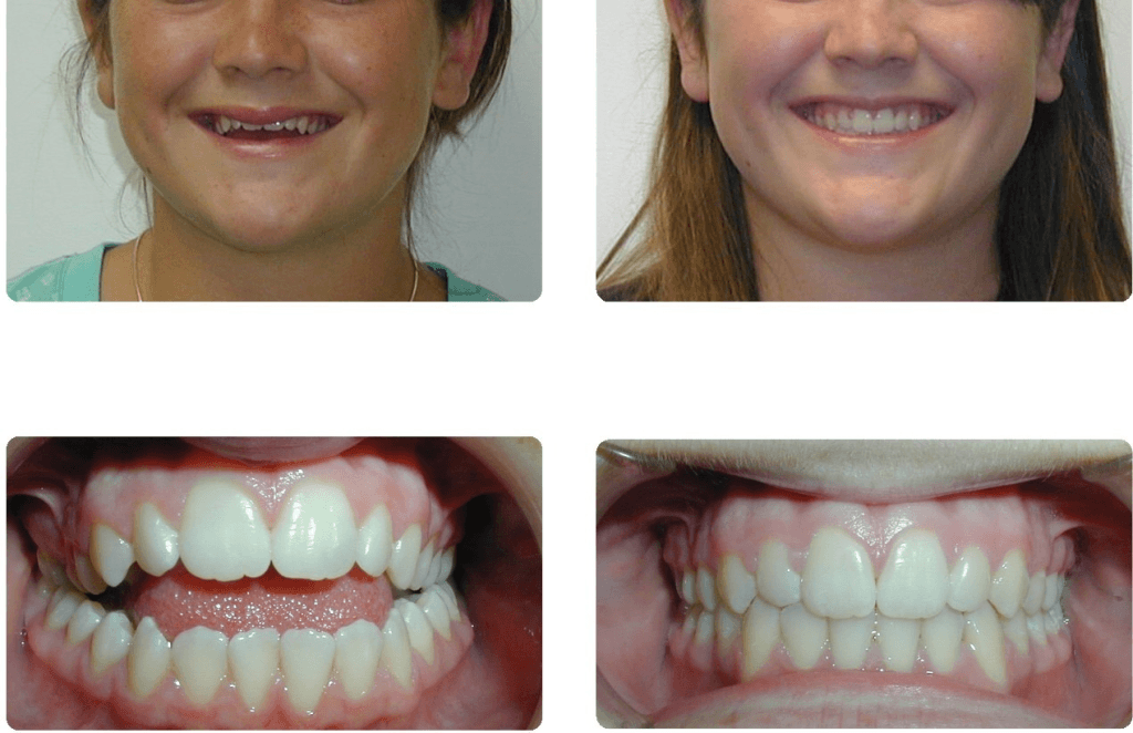 Opening Up The Bite: How To Improve Your Bite And Your Smile | Dentist ...