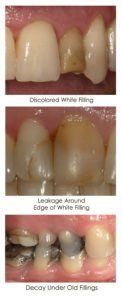 Discolored Fillings: What To Do When Your Fillings Look Bad | Dentist ...