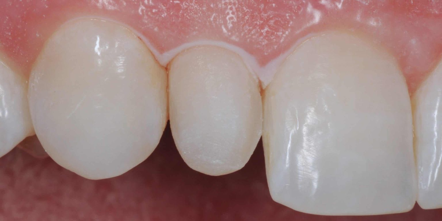 Peg Laterals: What They Are And How To Treat Them | Dentist Norcross ...