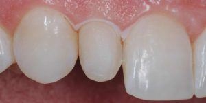 Peg Laterals: What They Are And How To Treat Them | Dentist Norcross ...