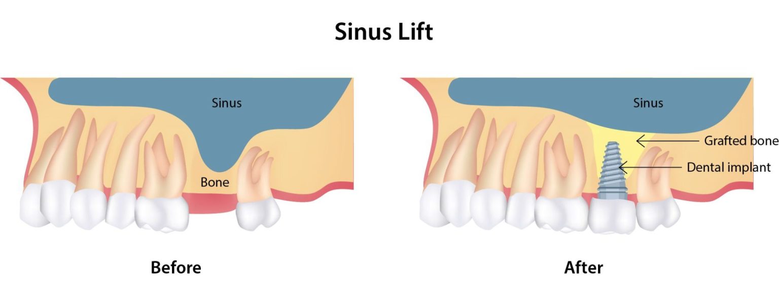Can Dental Implants Affect Sinuses? | Dentist Norcross & Alpharetta, GA