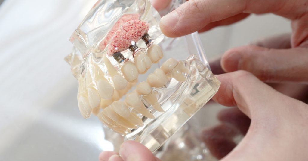 Can You Have An MRI With Dental Crowns? | Dentist Norcross & Alpharetta, GA