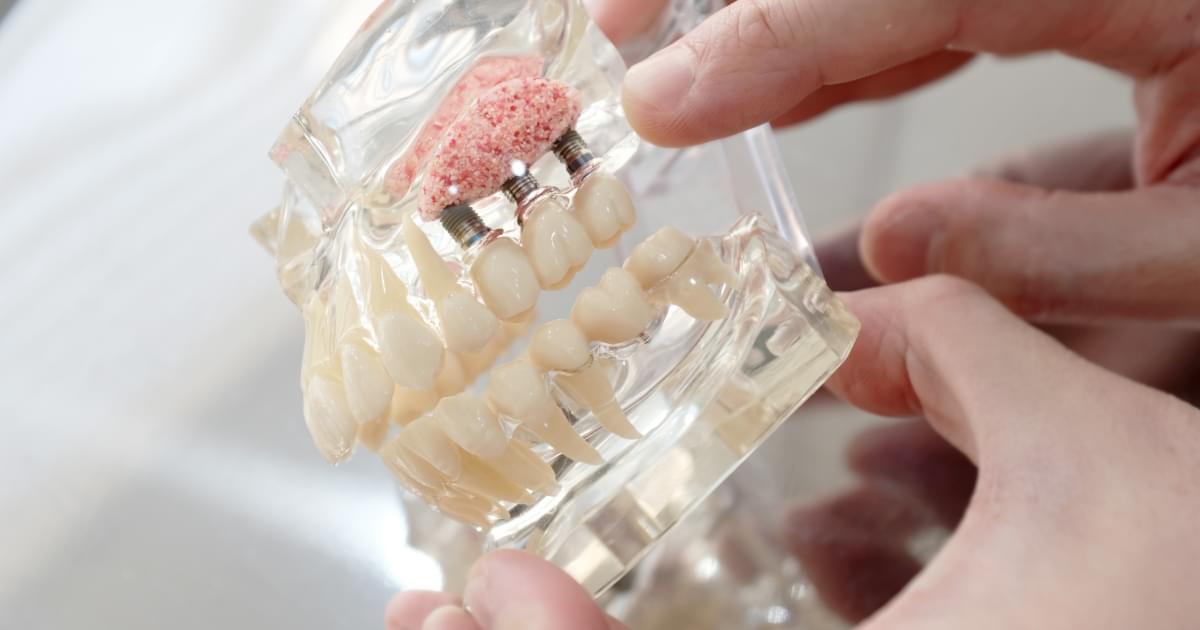 Discolored Fillings: What To Do When Your Fillings Look Bad | Dentist ...